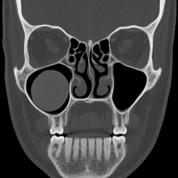 Zyste Kieferhöhle: Kieferchirurgie Konstanz MKG Dr Dr M Draheim