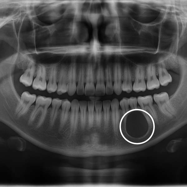 Mukozele Lippe: Kieferchirurgie Hussenpassage MKG Konstanz